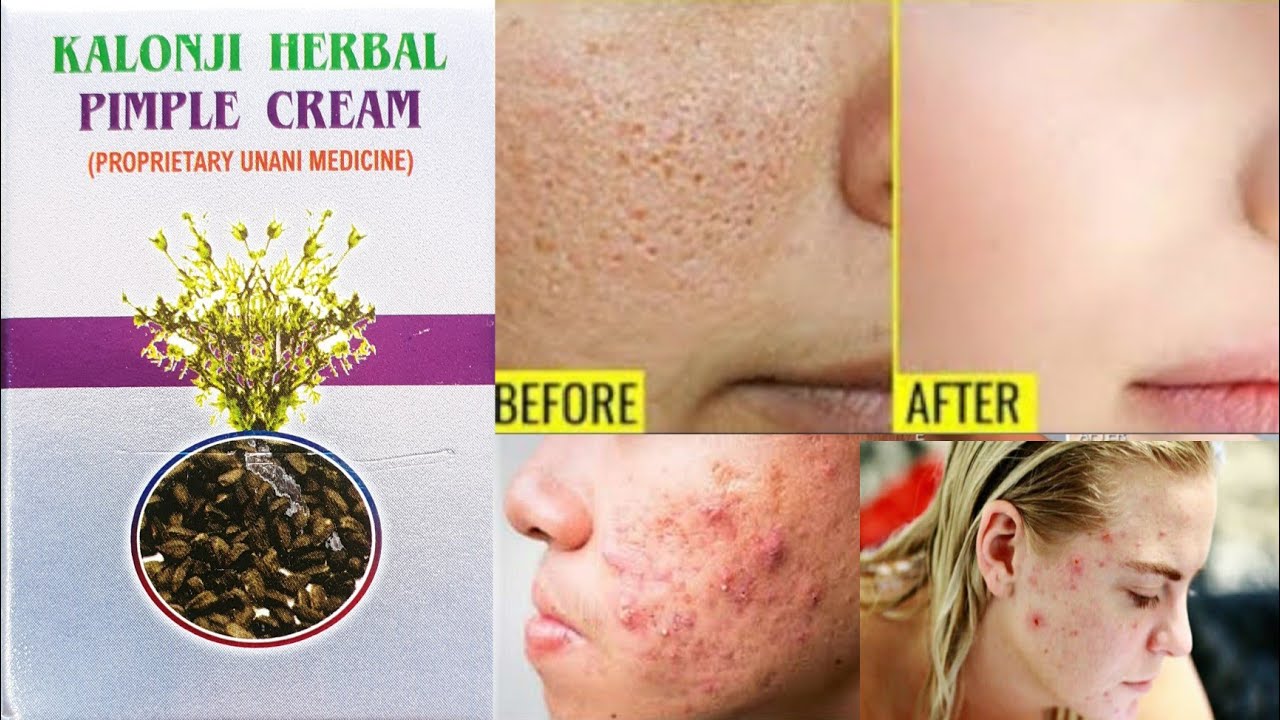 Kalonji Herbal Pimple Cream।। Kalonji Herbal Pimple Cream Review In ...