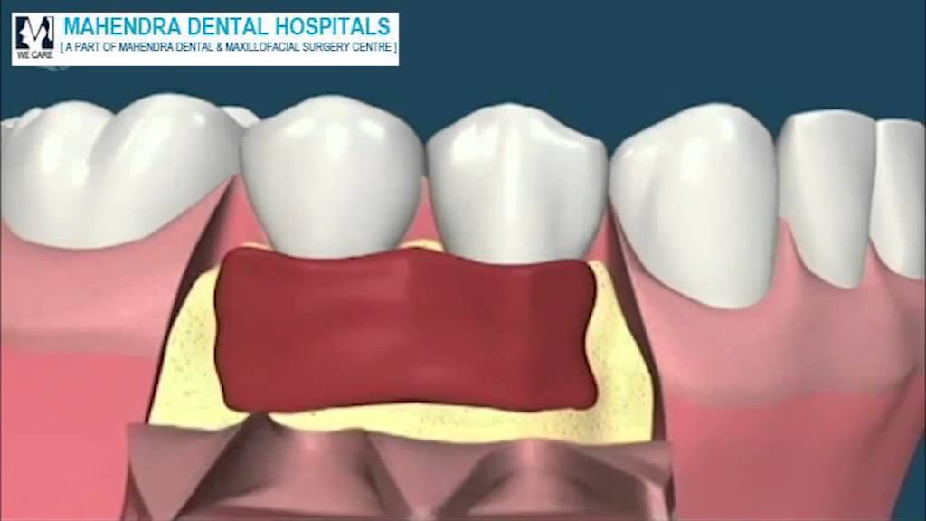 Gum Surgery Hyderabad | Bleeding Gum Treatment India - YouTube