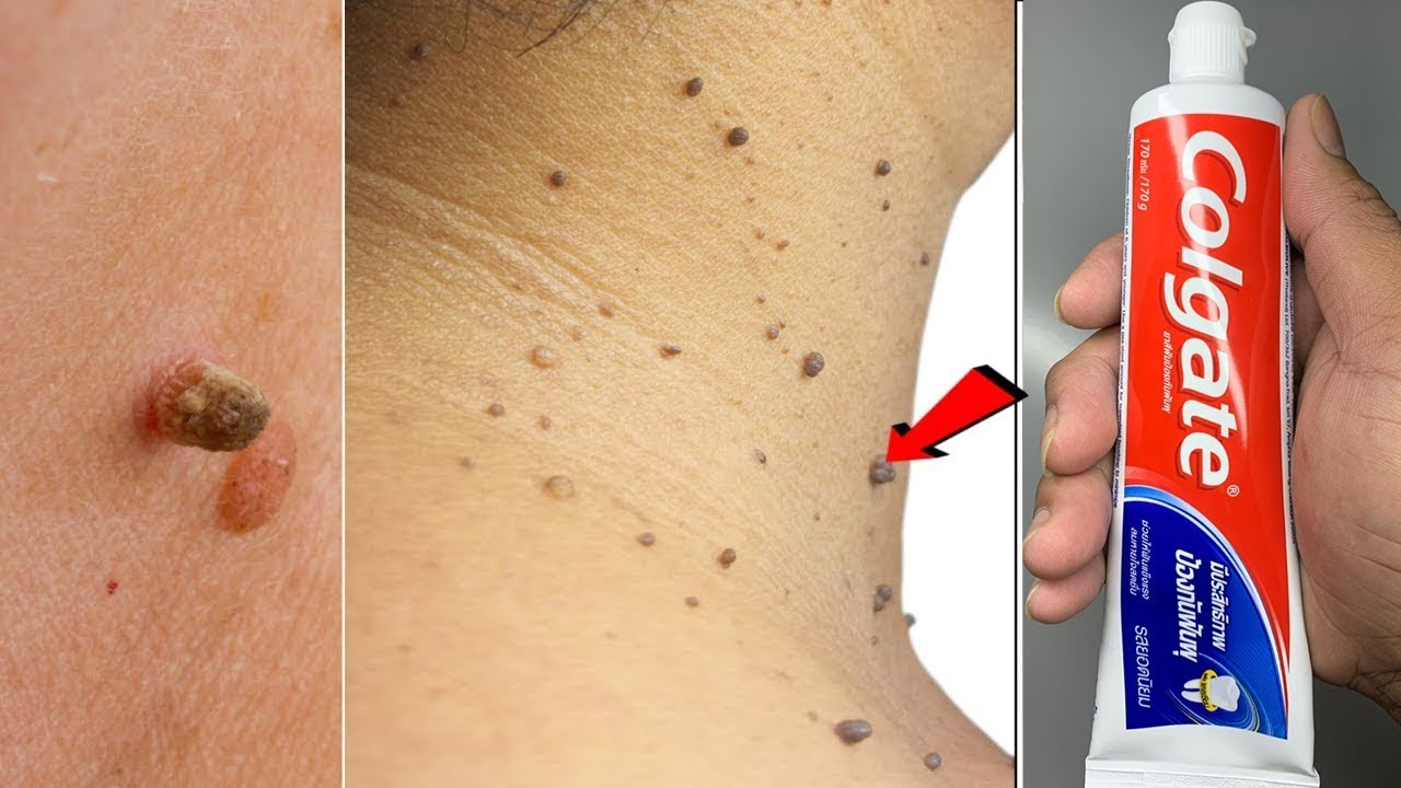 Best Way To Eliminate Sesame & Wart From Root-Remove Skin Tag Naturally ...