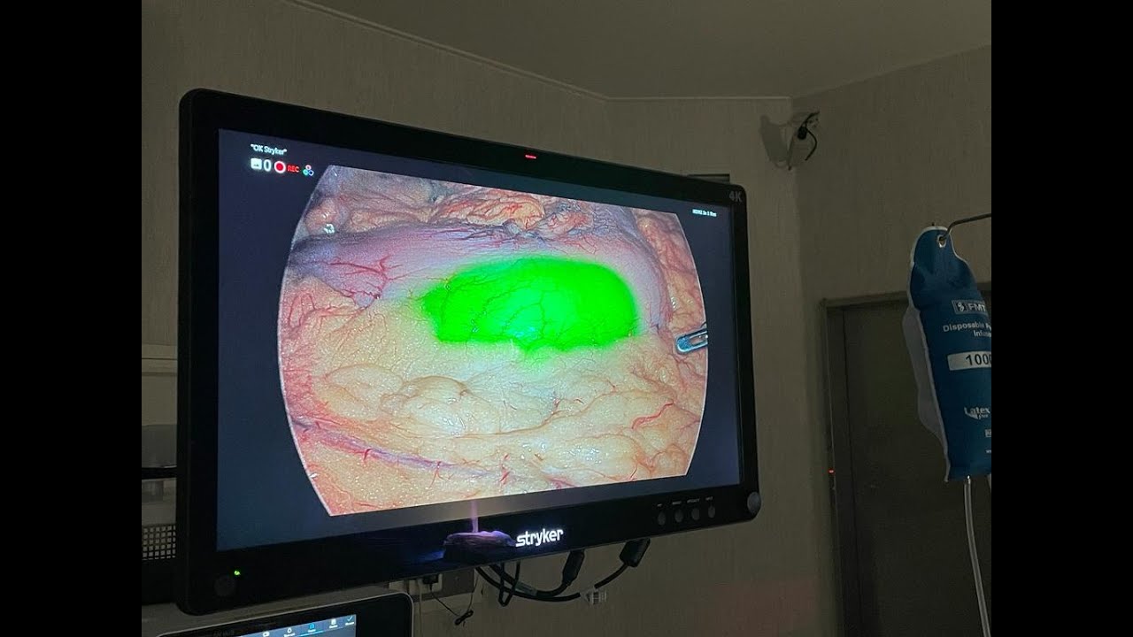 Enhancing surgical precision in gastric cancer:Endoscopic ICG injection ...
