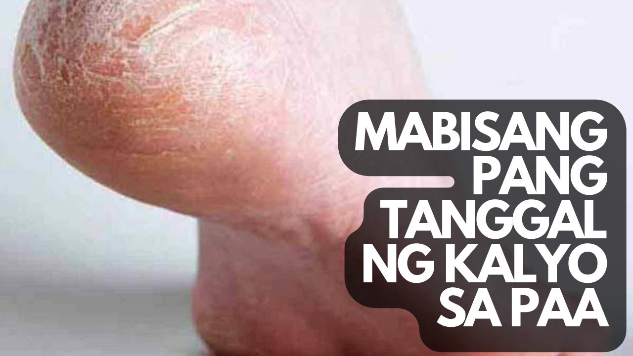 MABISANG PANG TANGGAL NG KALYO SA PAA. - YouTube