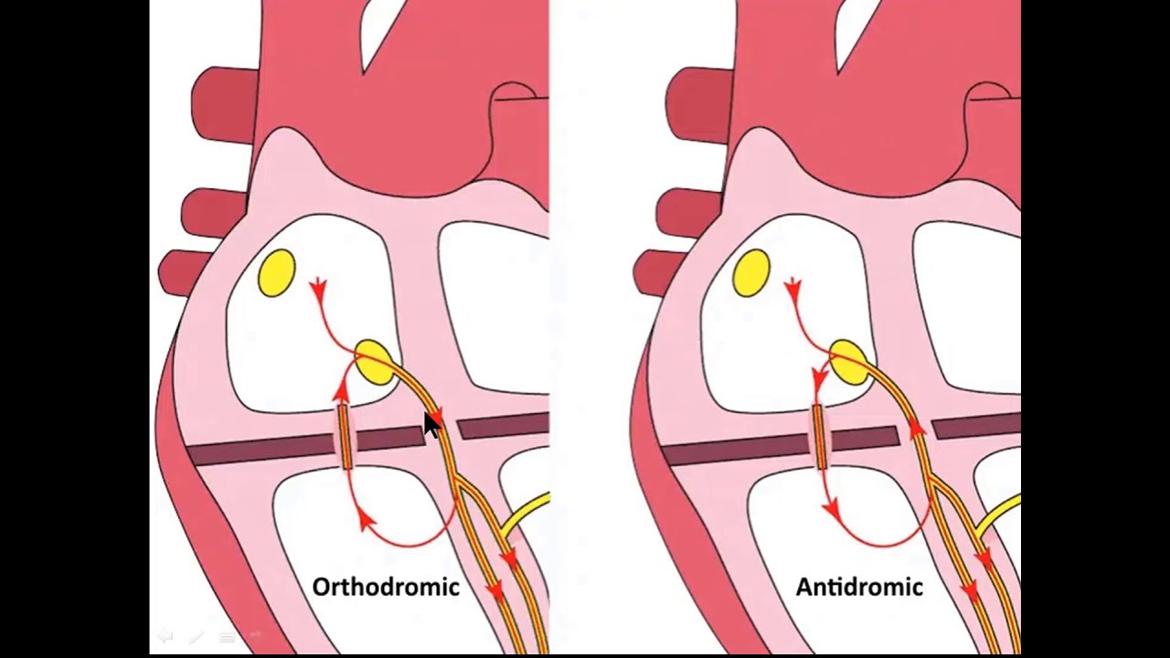 ECG, part 3, SVT, Atrioventricular re-entry tachycardia (AVRT) - YouTube