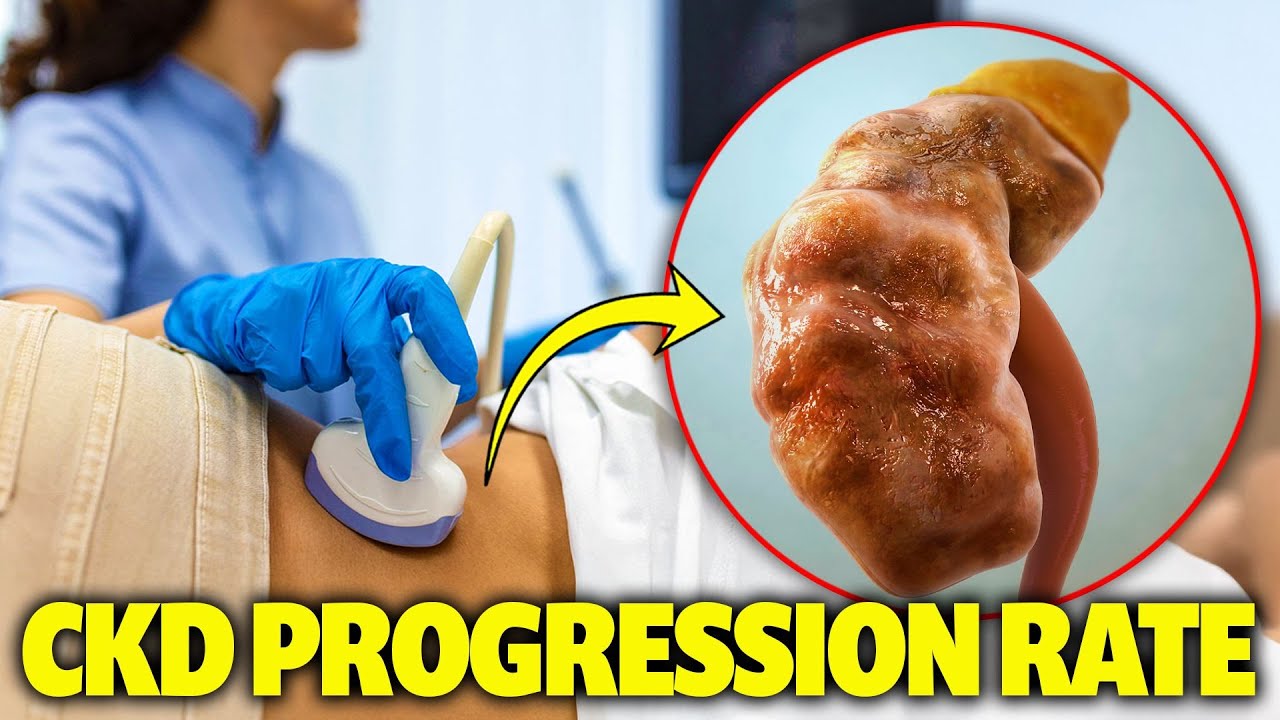 How Fast Does Chronic Kidney Disease Progress? Learn To Rejuvenate ...