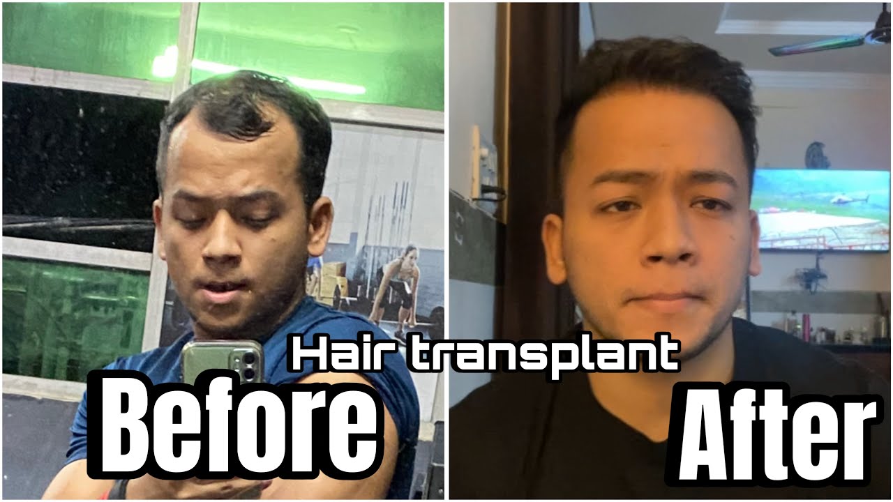 Hair Transplant Time lapse | Day 1 to Day 365 | Growth in 1 year ...