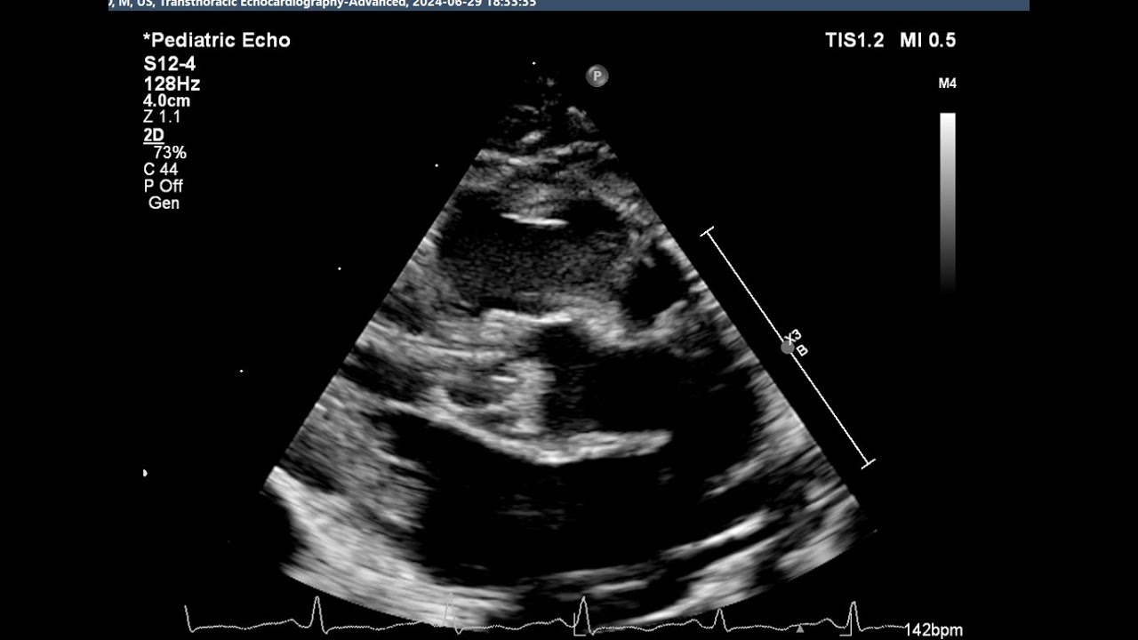 Basic echocardiography(심장 초음파 기본)- Bicuspid aortic valve, dysplastic aortic valve - YouTube