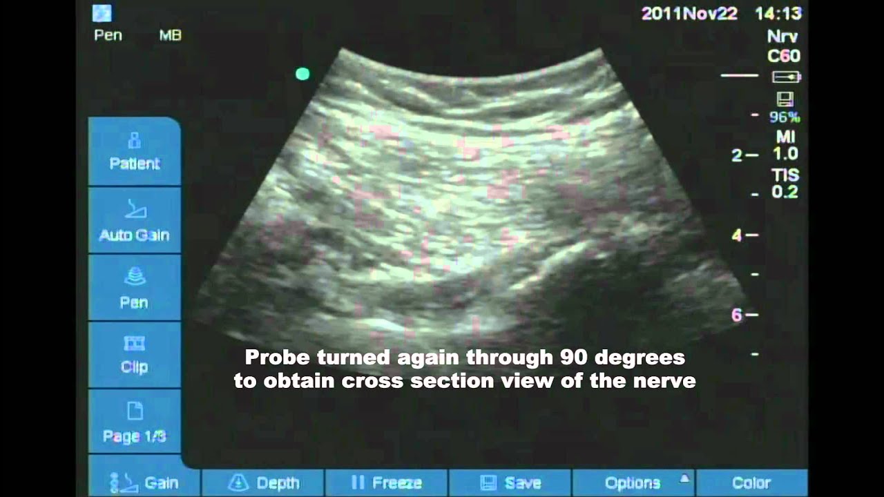 Posterior approach to sciatic nerve - YouTube