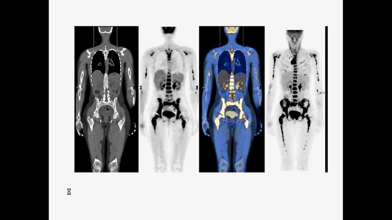 Talk on TIFFA Scan by Dr. Rijo Mathew - Part I - YouTube