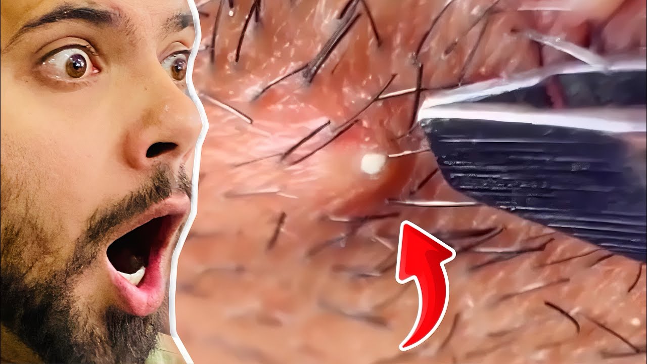 Popping huge blackheads and Giant Pimples- Best Pimple Popping Videos ...