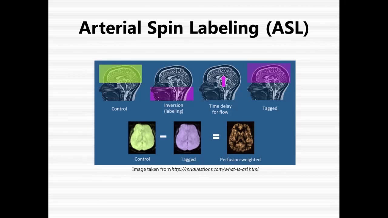 Ömer Kağan Kabalak - Pseudo Continuous Arterial Spin Labeling (pCASL ...
