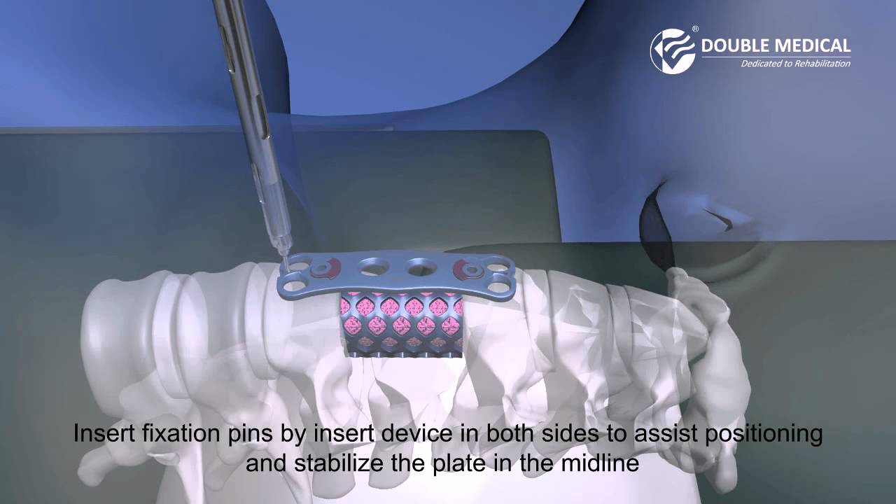 Anterior Cervical Locking Plate I - YouTube