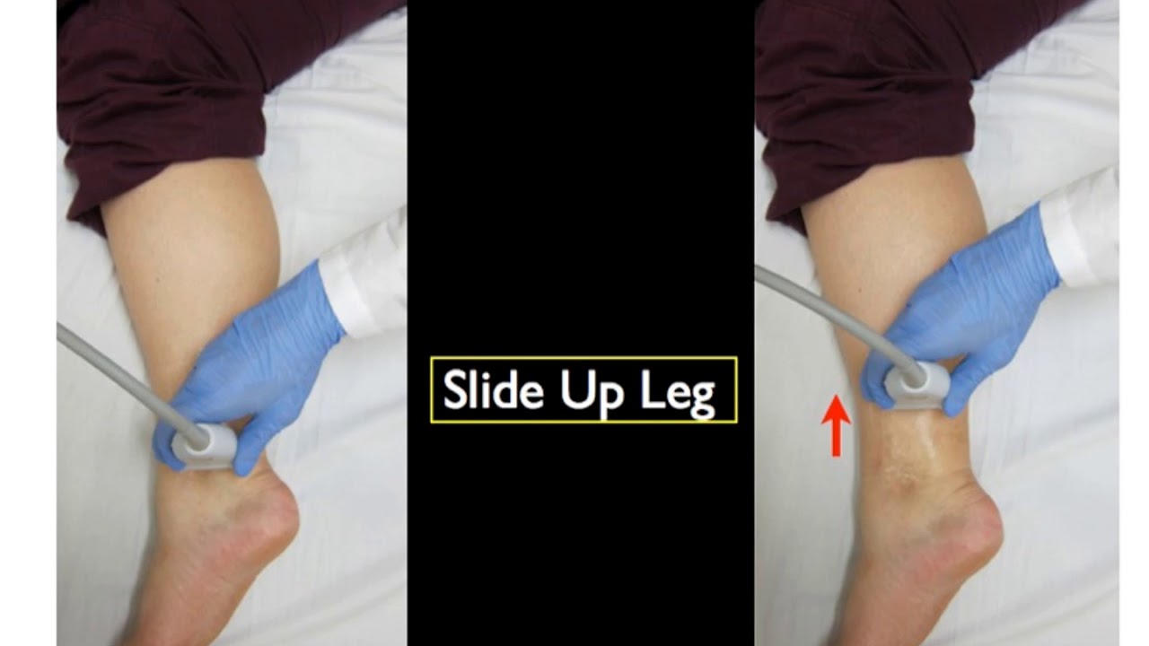 Posterior Tibial Nerve Block - YouTube