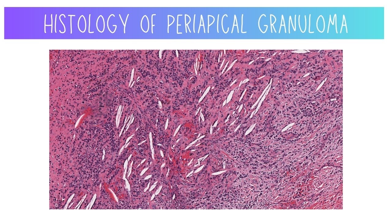 Periapical Granuloma Histology Odontogenic Keratocyst Wikipedia