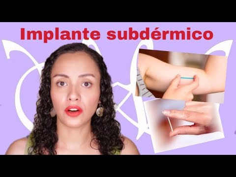 TODO LO QUE DEBES SABER SOBRE EL IMPLANTE ANTICONCEPTIVO (SUBDÉRMICO) 🙃 ...