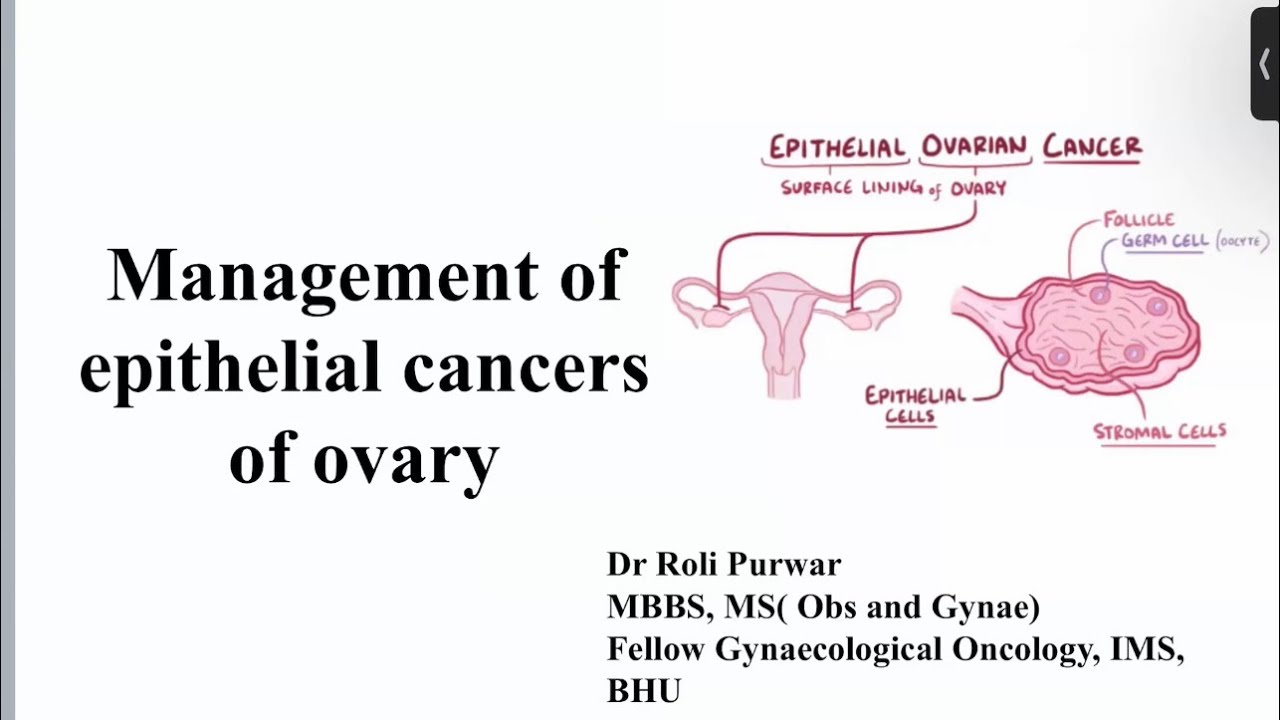 Understanding Epithelial Ovarian Cancer: Statistics, Trends, and ...