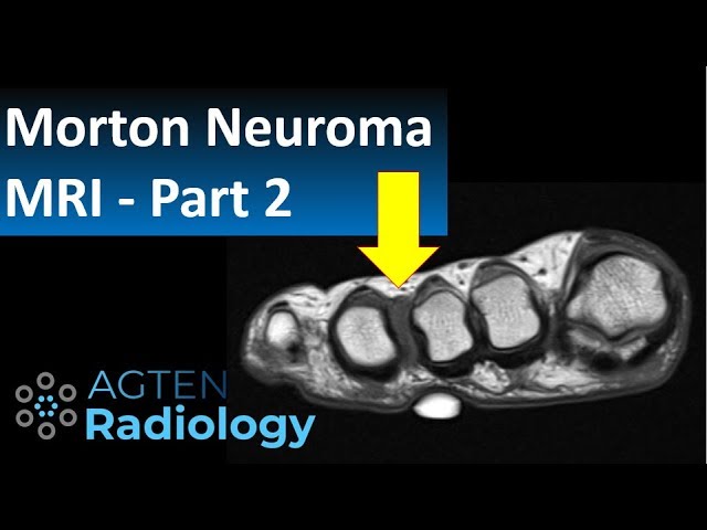 Mortons Neuroma Mri Morton Neuroma: Evaluated With Ultrasonography And