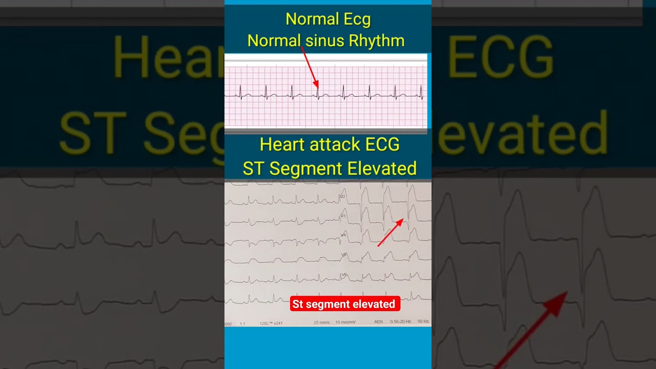 Heart Attack Ecg Line Graphics Medical Electrocardiogram Stock