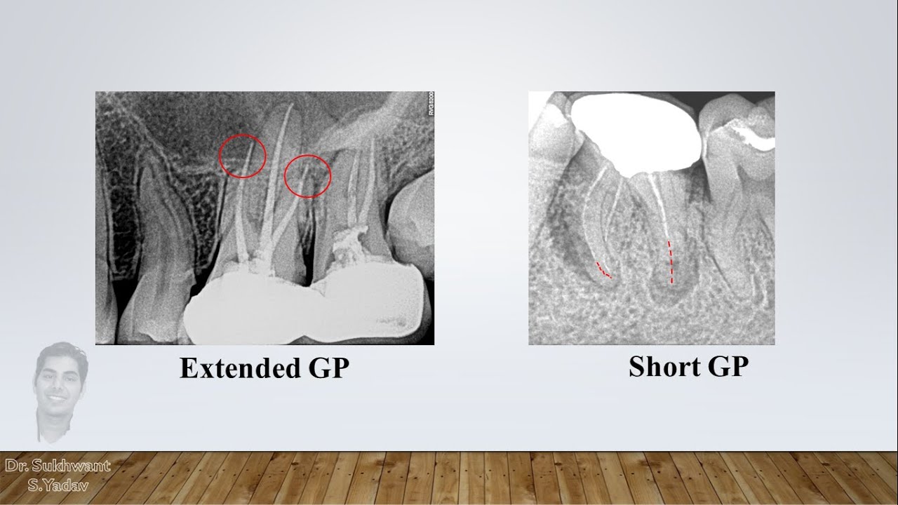 GP Removal - YouTube