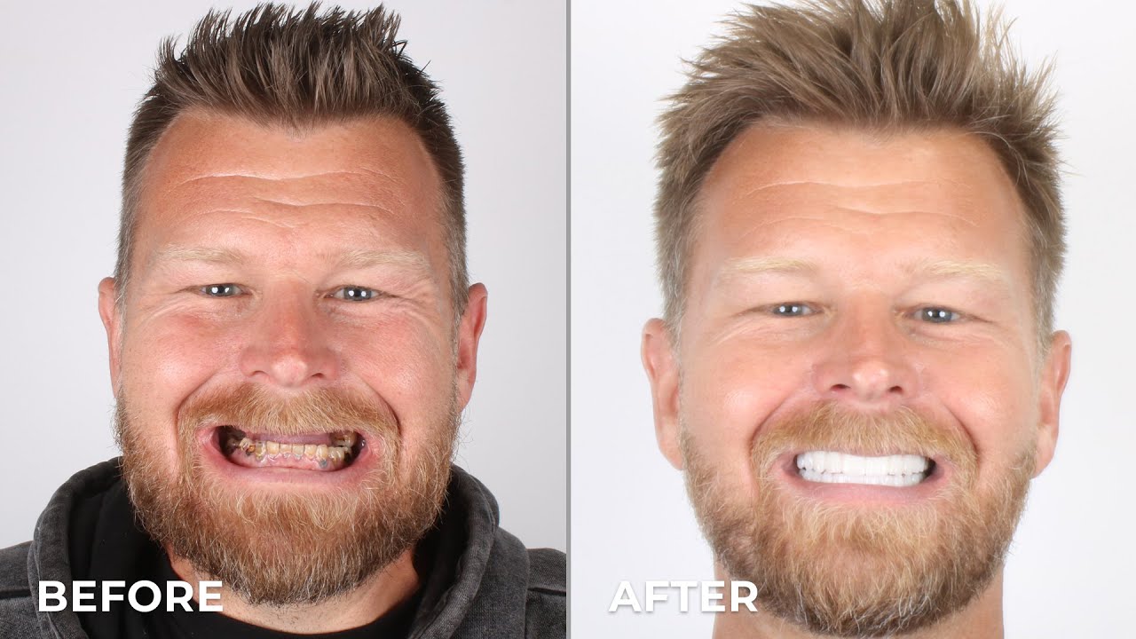 Check Out Brandon's Transformation After Getting Dental Implants! - YouTube