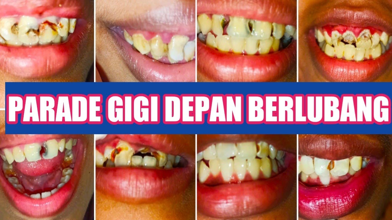 parade kompilasi karies gigi depan,berbagai bentuk lubang gigi depan ...