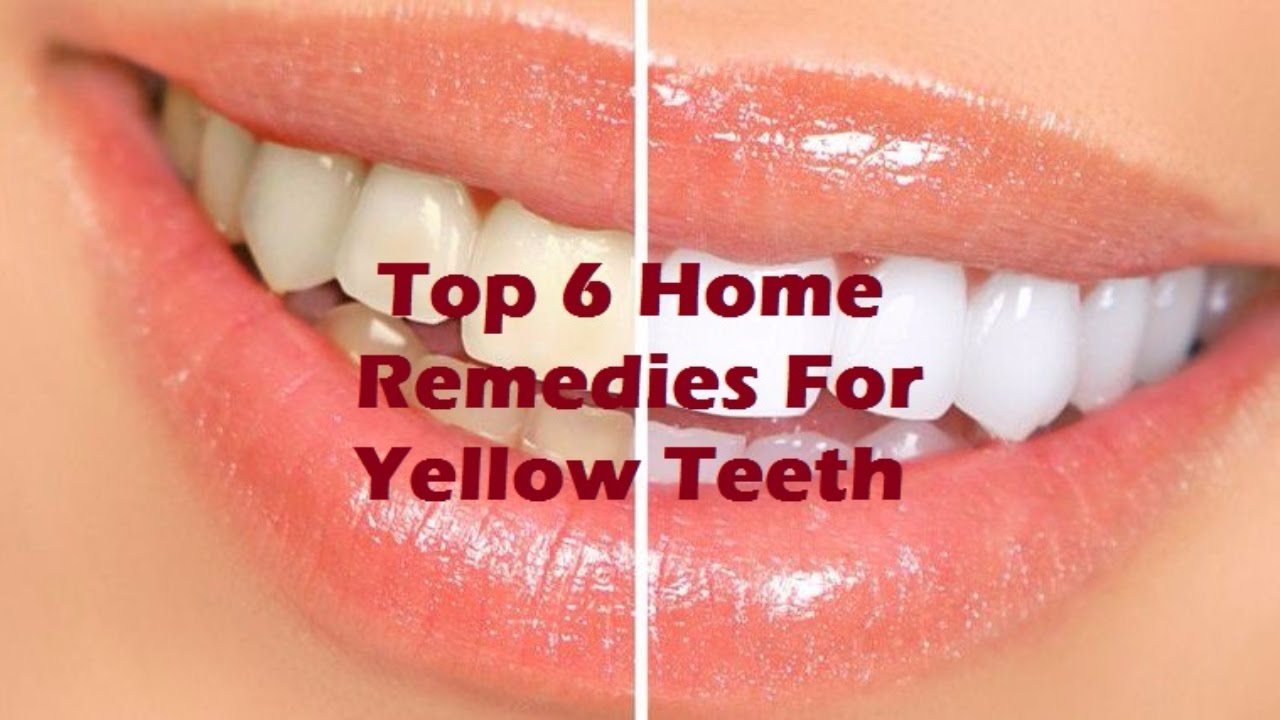 Top 6 Home Remedies For Yellow Teeth | Yellow Teeth Fix Solution - YouTube