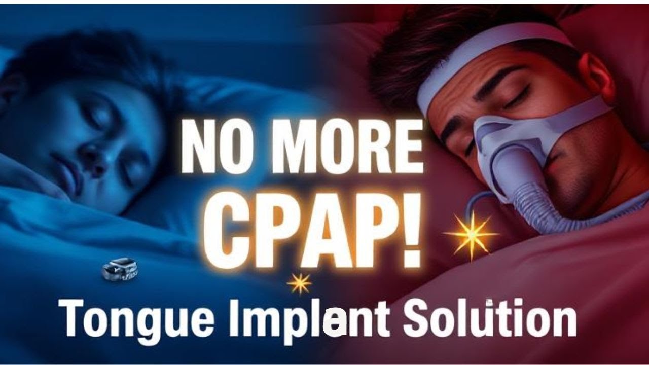 🚨 Tongue Implant for Sleep Apnea? 😴 No More CPAP Machines! | Healthy ...