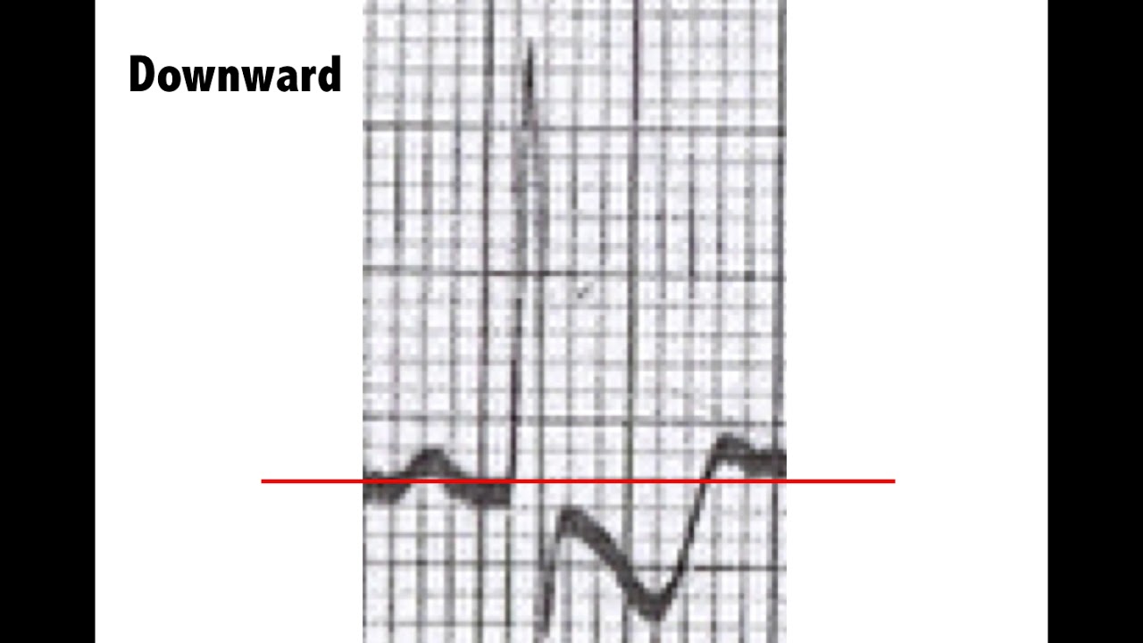 Evaluating St Segments for EKG Interpretation/ECG Interpretation - YouTube
