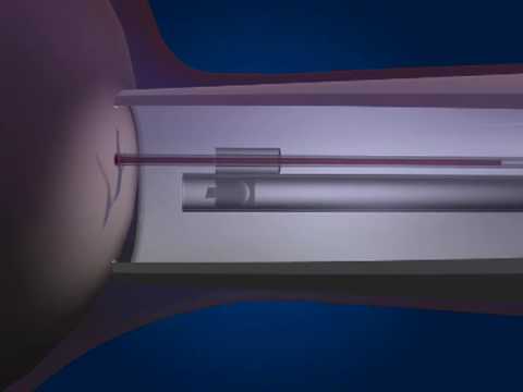 DIGITALmotion: Medical Animation - Fetal Blood Sampling Kit - YouTube