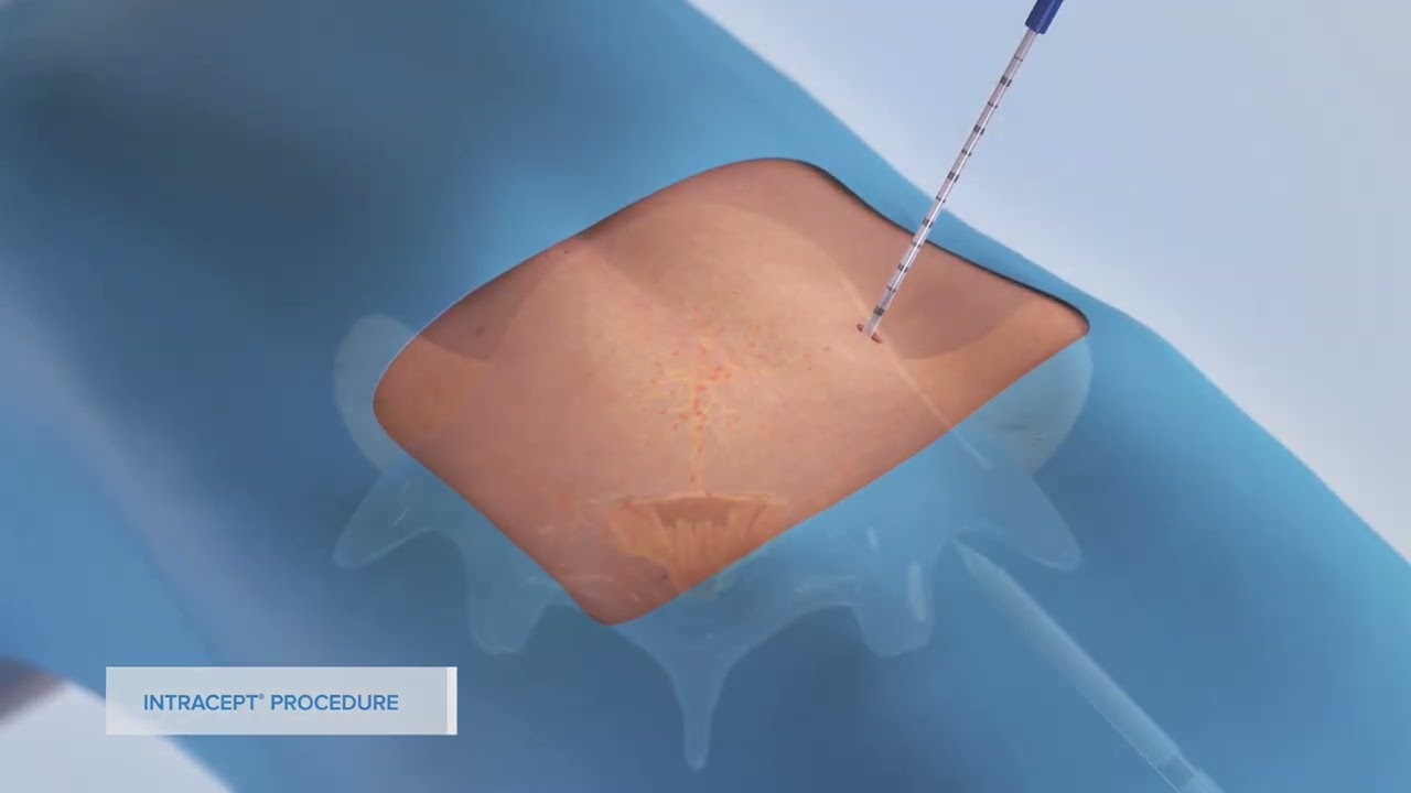 Intracept Procedure 3D Animation - Reno, Nevada - YouTube