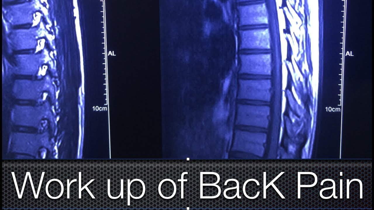 Work up of Serious Back Pains - YouTube