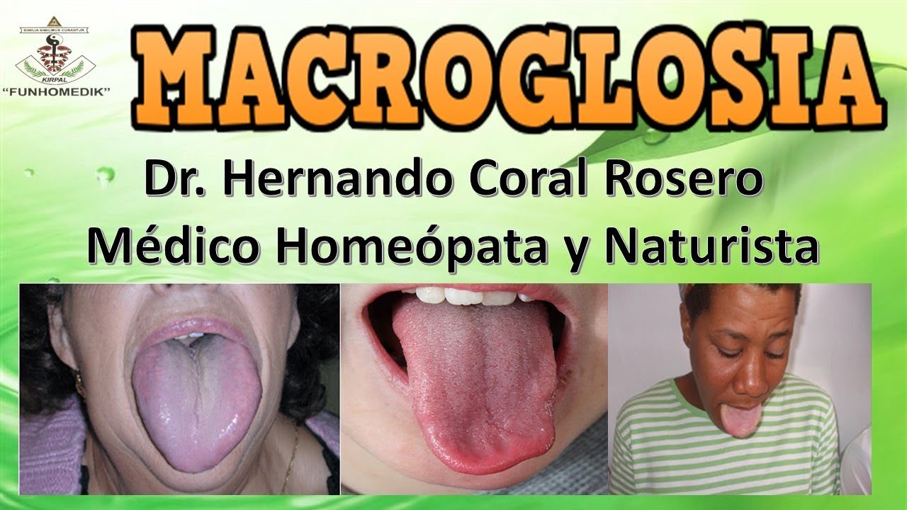 MACROGLOSIA - INCREMENTO EN EL TAMAÑO DE LA LENGUA - YouTube
