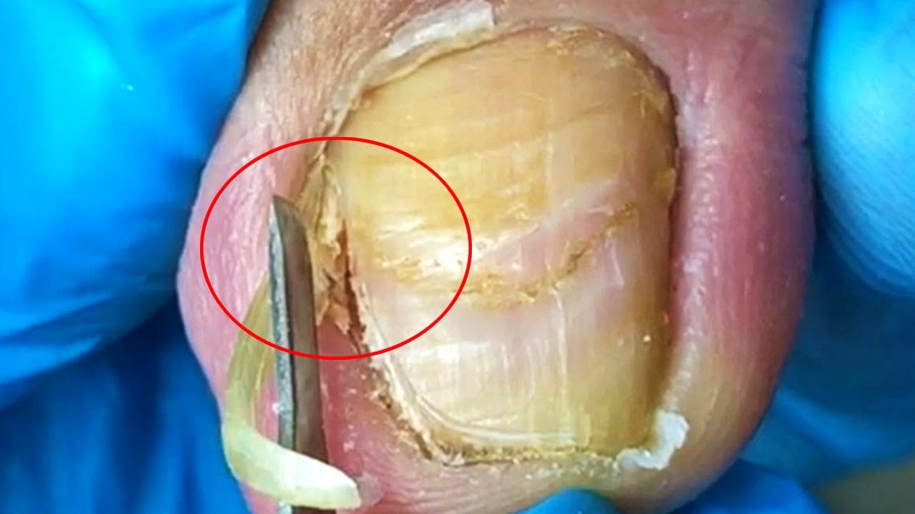 Deteriorated Toenail Trimming…Foot Care【Crazy pedicure room】 - YouTube