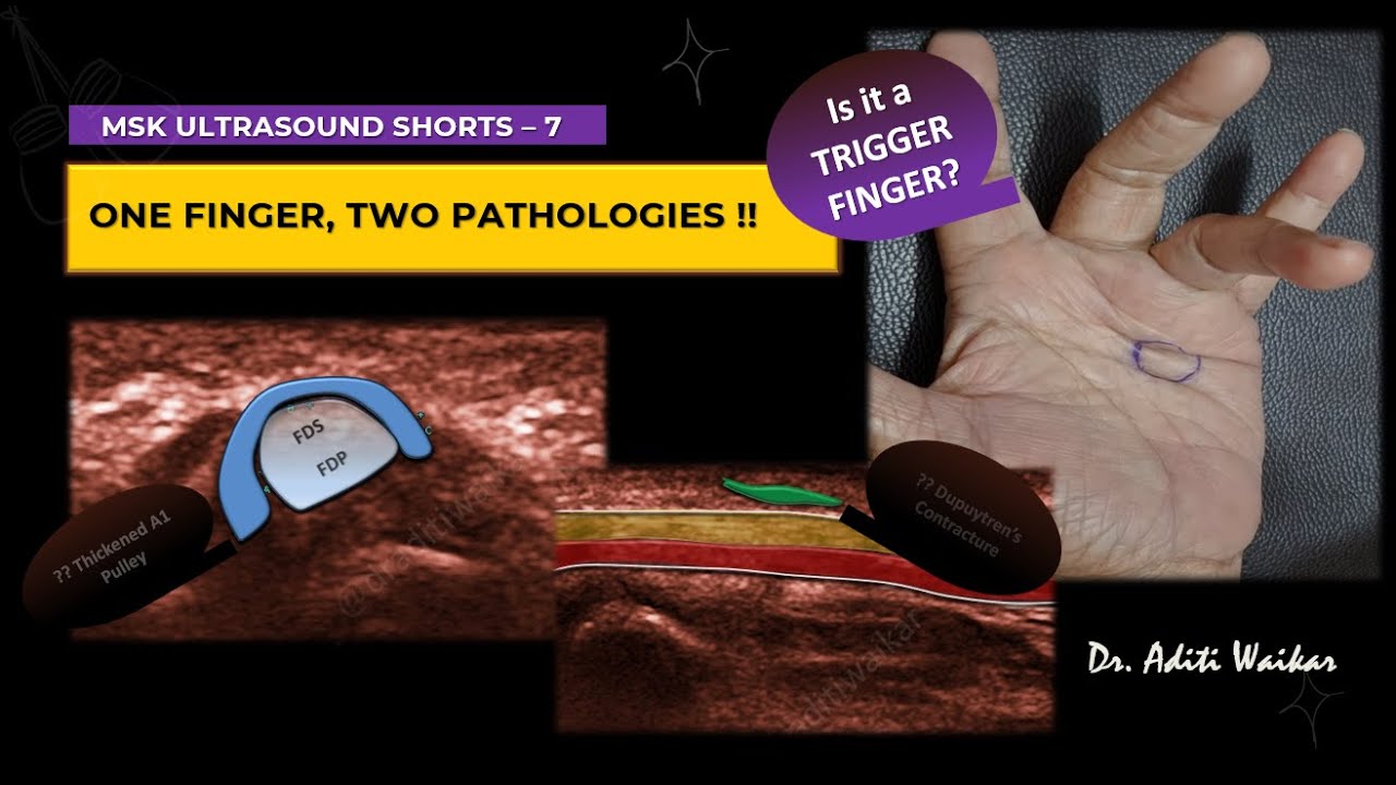 MSK ultrasound shorts 7 - An Interesting Case of Trigger Finger - YouTube