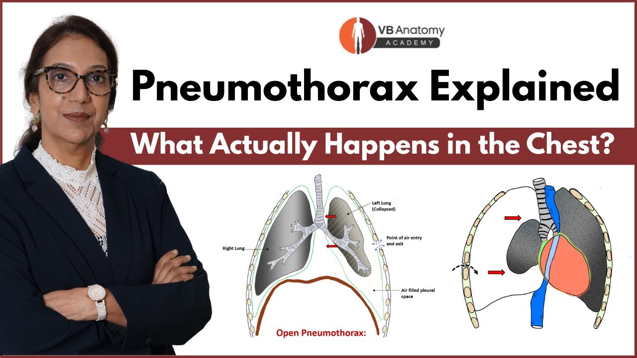 Pneumothorax Explained | Anatomy, Causes, Open vs Tension Pneumothorax ...