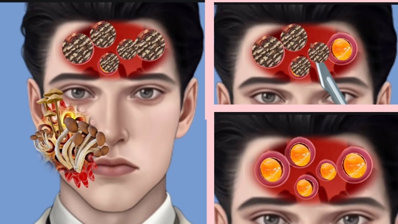 ASMR Dirt & Pustules Removal/Face tone Spa/Fungus Removal/Severely ...