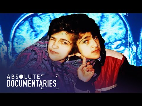 The Incredible Separation: The Conjoined Twins' Pioneering Surgical Journey | Absolute Docum