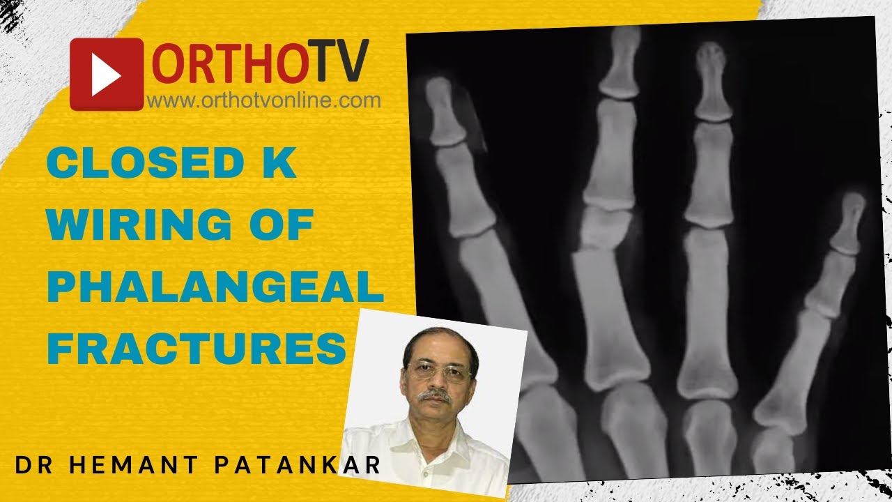 Closed K Wiring of Phalangeal Fractures - Dr Hemant Patankar - YouTube
