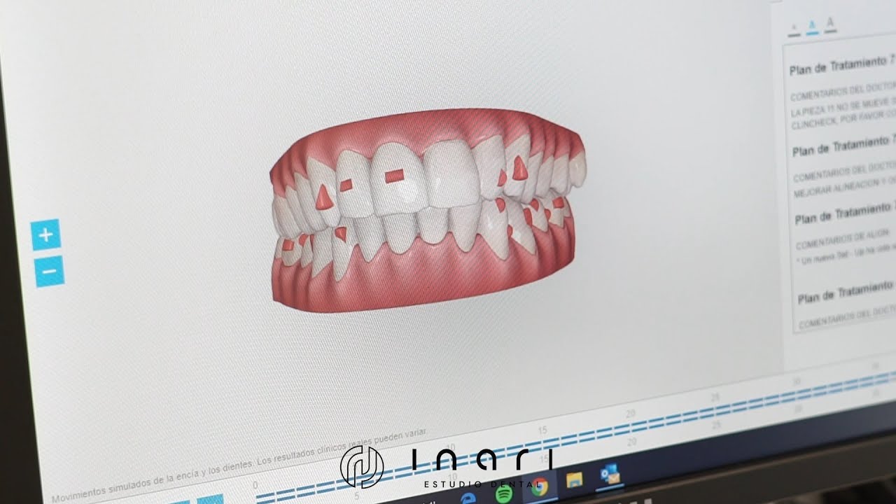 Clincheck Invisalign - YouTube