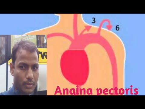 Angina pectoris class 2 - YouTube