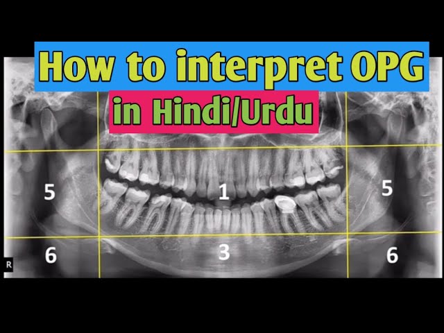 Orthopantomogram Meaning Why Use A Palatal Expander In Orthodontics?