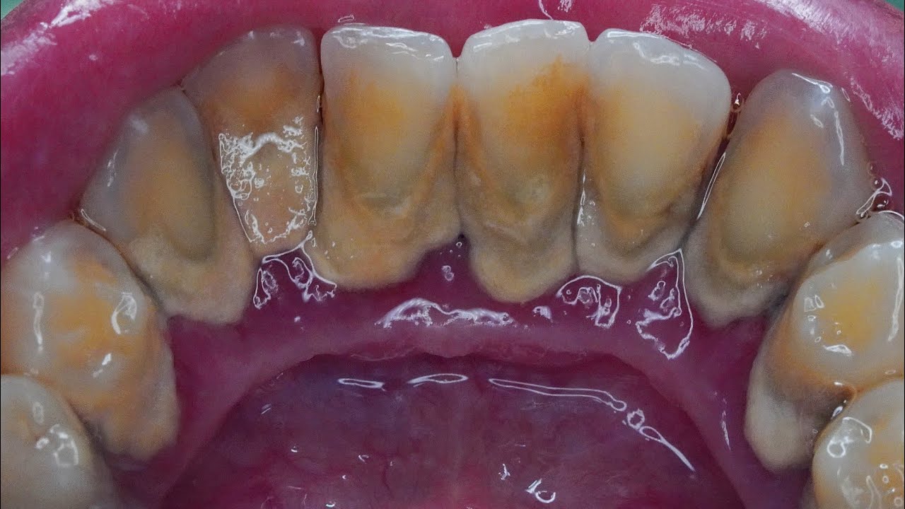 Scale your tartar routinely, at least once every 6 months | Dentist ...