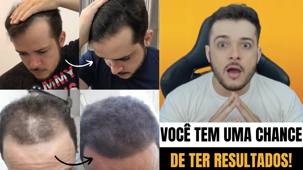 É Possível Nascer Novos Fios em Áreas Carecas? Descubra Como Estimular ...