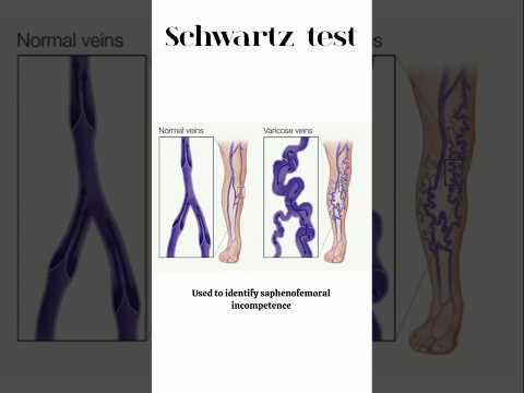 #shortsfeed #physiotherapist schwartz test  #anatomy #viralvideo #duet 🩺💯🏥👨‍⚕️