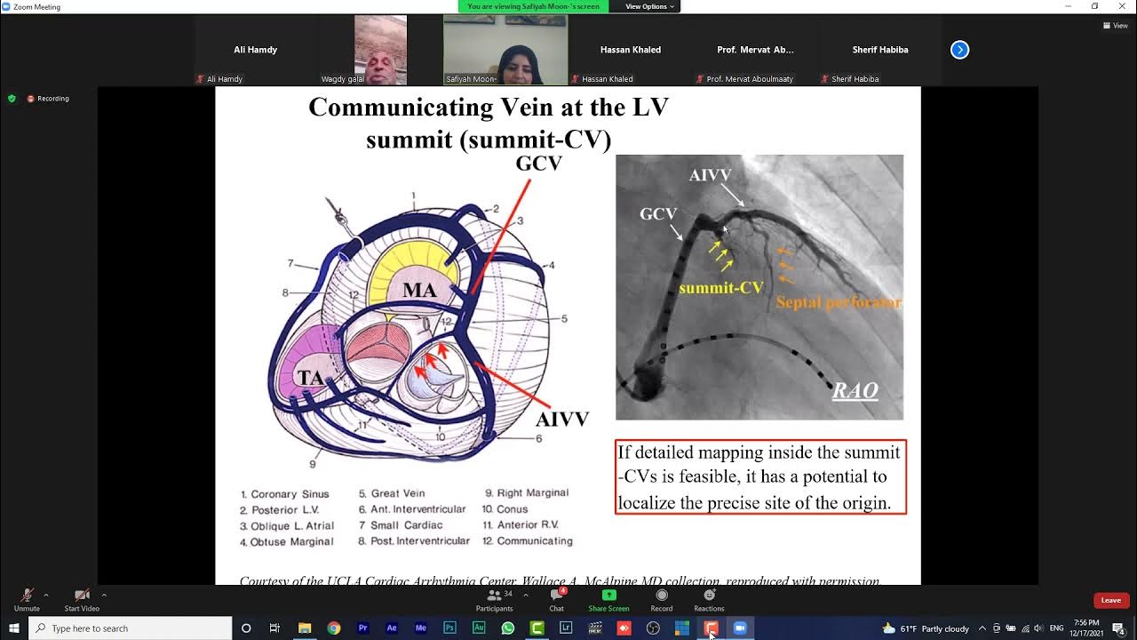 How To Map And Ablate Lv Summit Ventricular Arrhythmias Dr Ghalia Al