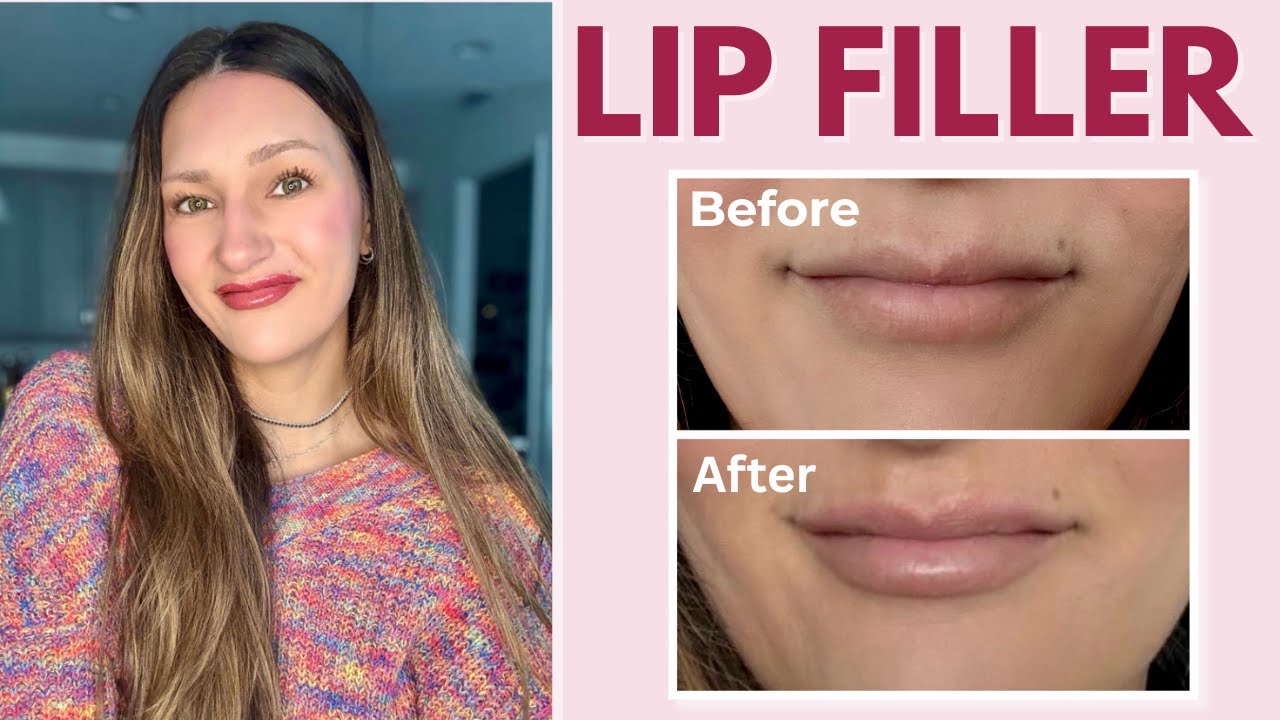 My First Lip Filler Experience | Before & After + 1 Week Healing - YouTube
