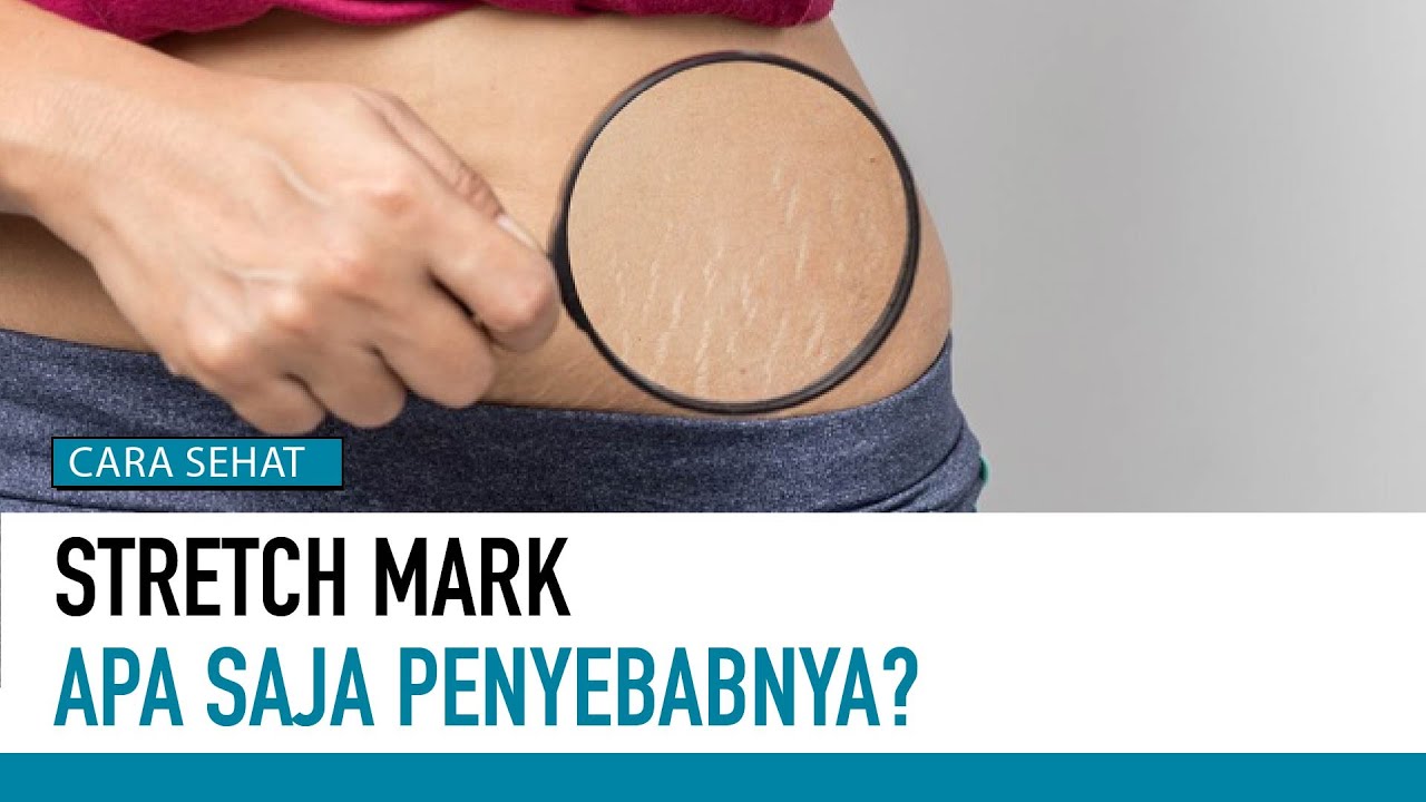 Apakah Stretch Mark Bisa Hilang Setelah Melahirkan? | Cara Sehat - YouTube