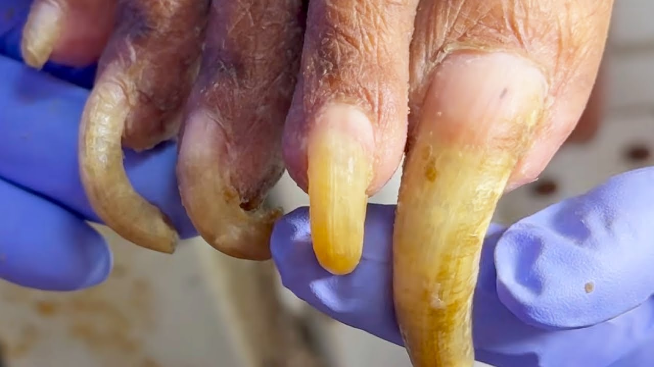 These Nails Are Too Long! Cut Them OffDoctor Liu Pedicure【Dr Liu's ...
