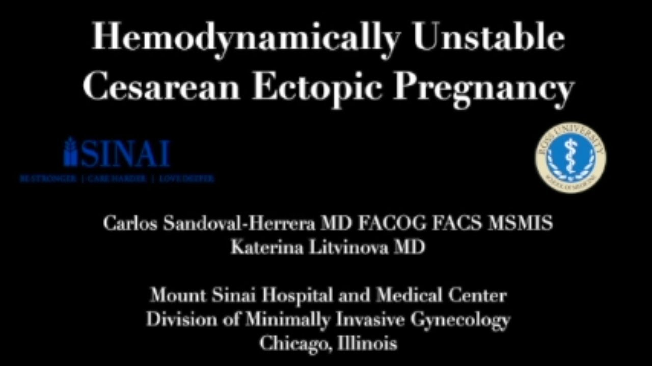Hemodinamically unstable cesarean ectopic pregnancy - YouTube