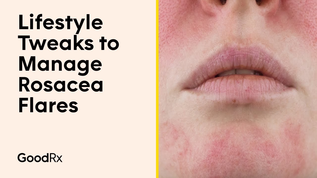Lifestyle Tweaks to Manage Rosacea Flares and Prevent Complications ...