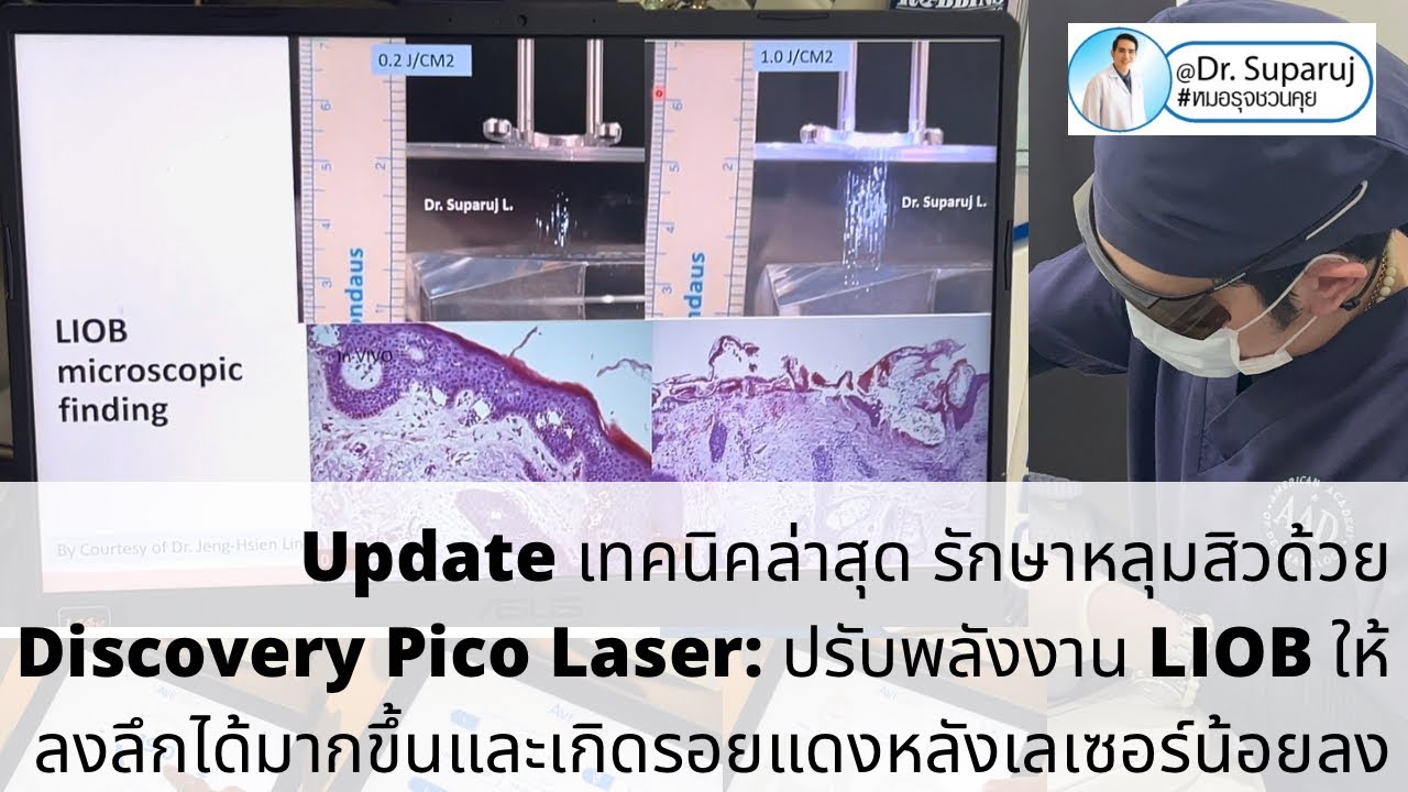 เทคนิคล่าสุดรักษาหลุมสิวด้วยเทคนิคโปรแกรมDiscovery Pico Laser:การปรับ ...