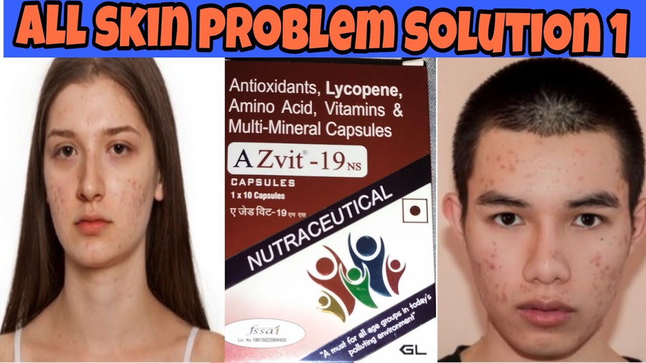 Azvit _19 ns capsule uses Benifit Side effects/ चेहरे की कोई भी समस्या ...